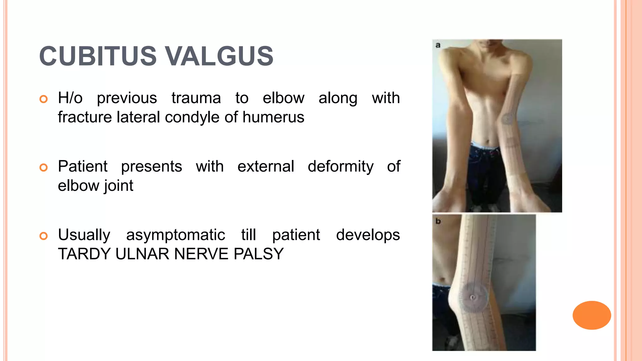 Cubitus varus and valgus | PPTX
