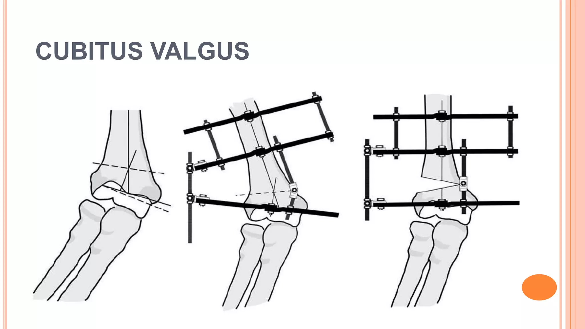 Cubitus varus and valgus | PPTX