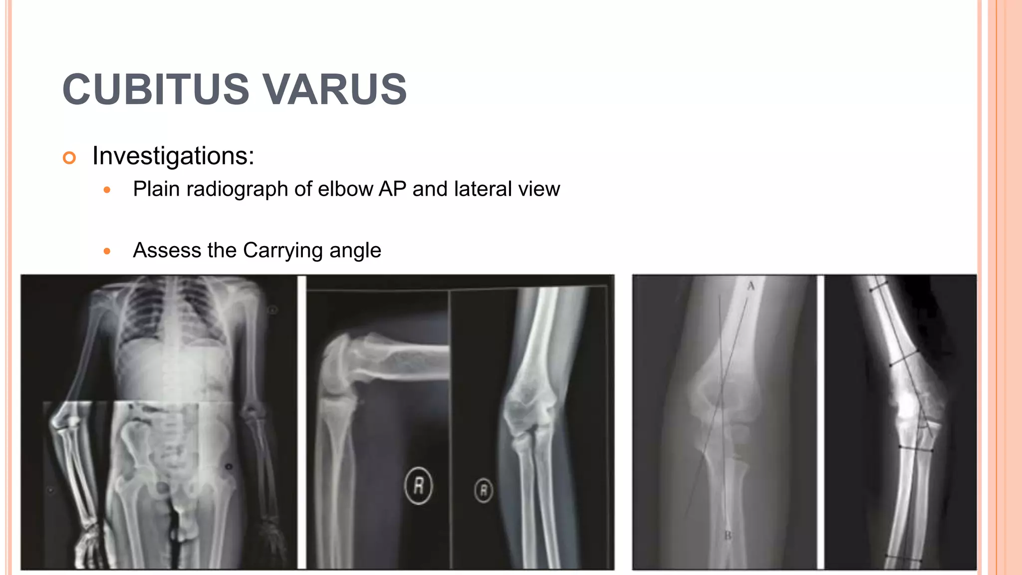 Cubitus varus and valgus | PPTX