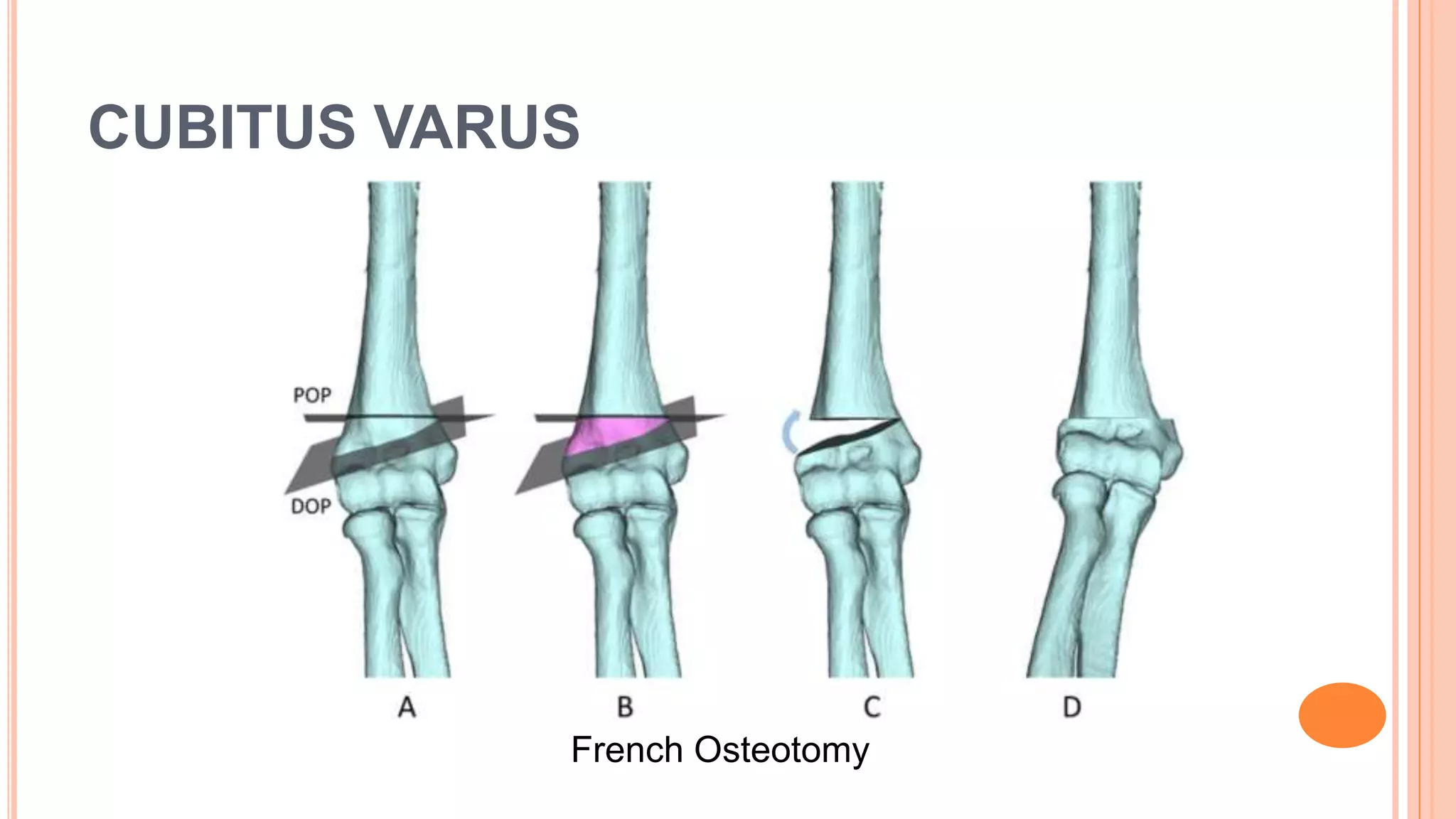 Cubitus varus and valgus | PPTX
