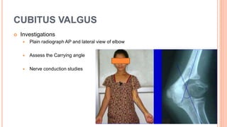 Cubitus Valgus And Cubitus Varus