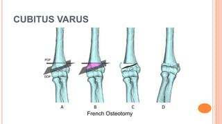 Cubitus Valgus And Cubitus Varus