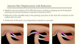 Temporomandibular Joint Disorders | PPT