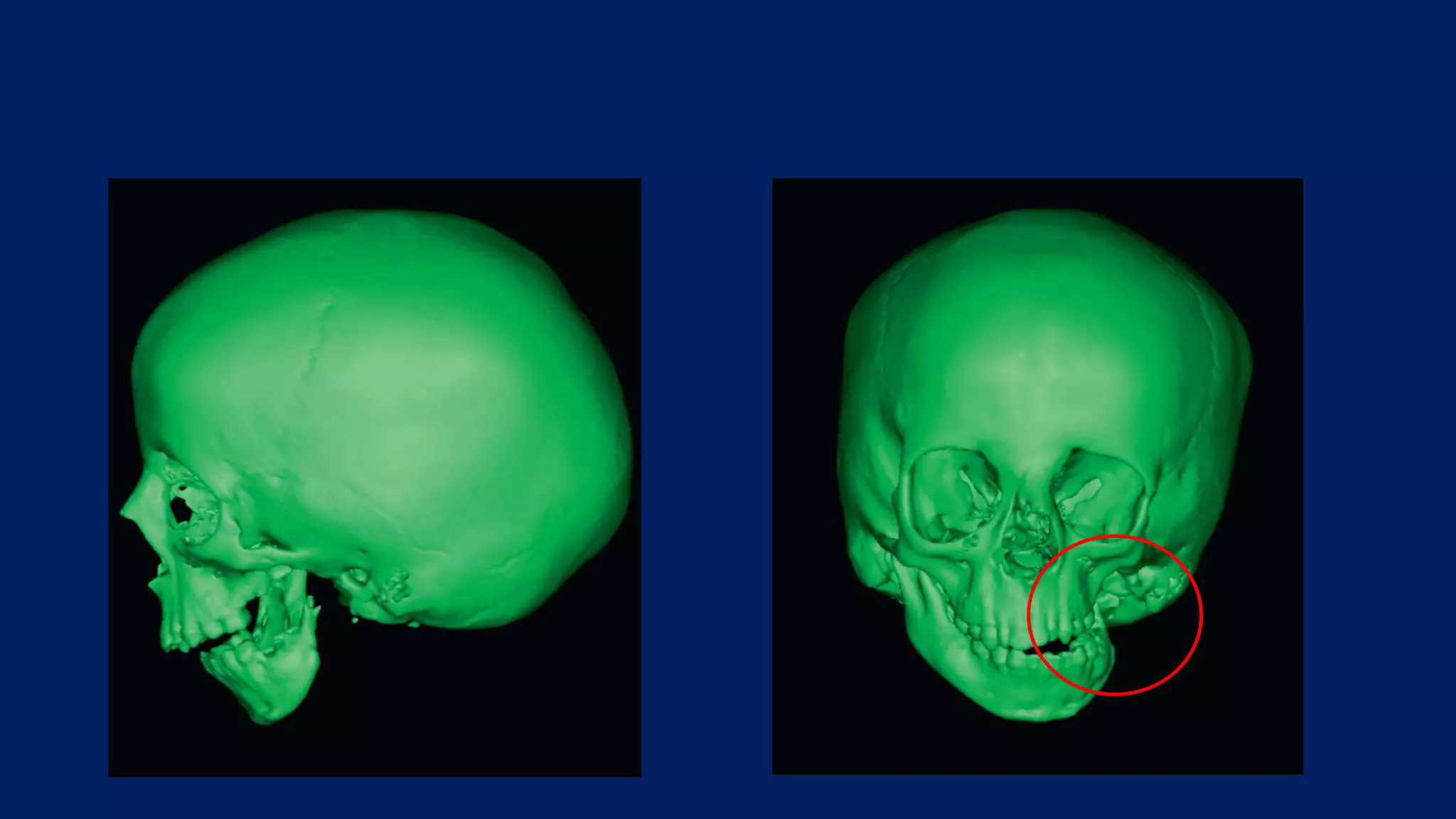 Craniofacial Microsomia and Hemifacial Atrophy | PPTX