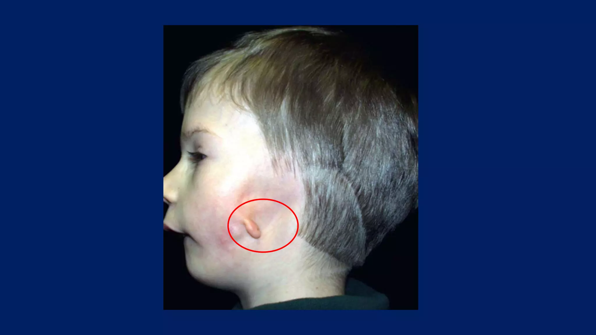 Craniofacial Microsomia and Hemifacial Atrophy | PPTX
