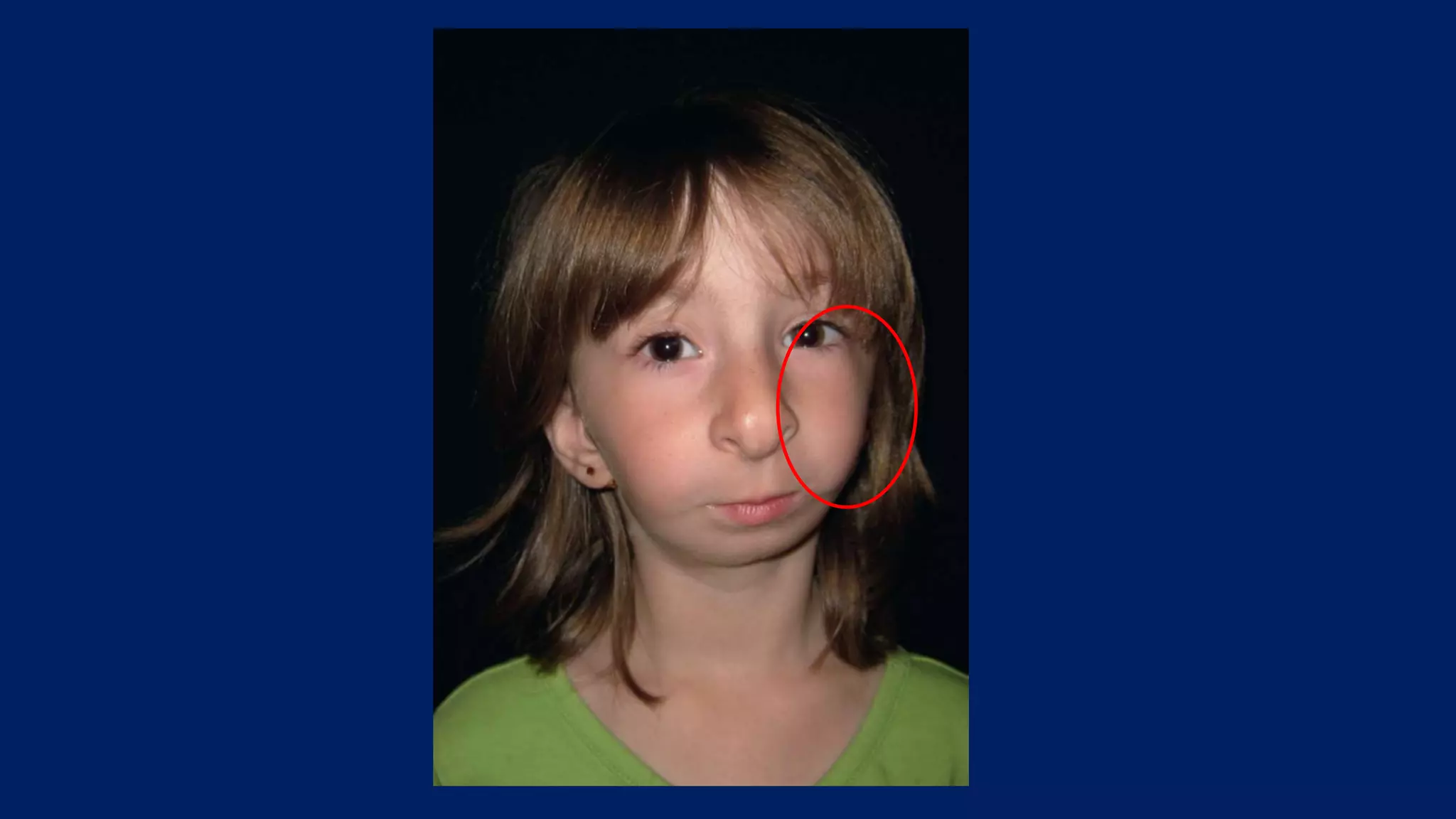 Craniofacial Microsomia and Hemifacial Atrophy | PPTX