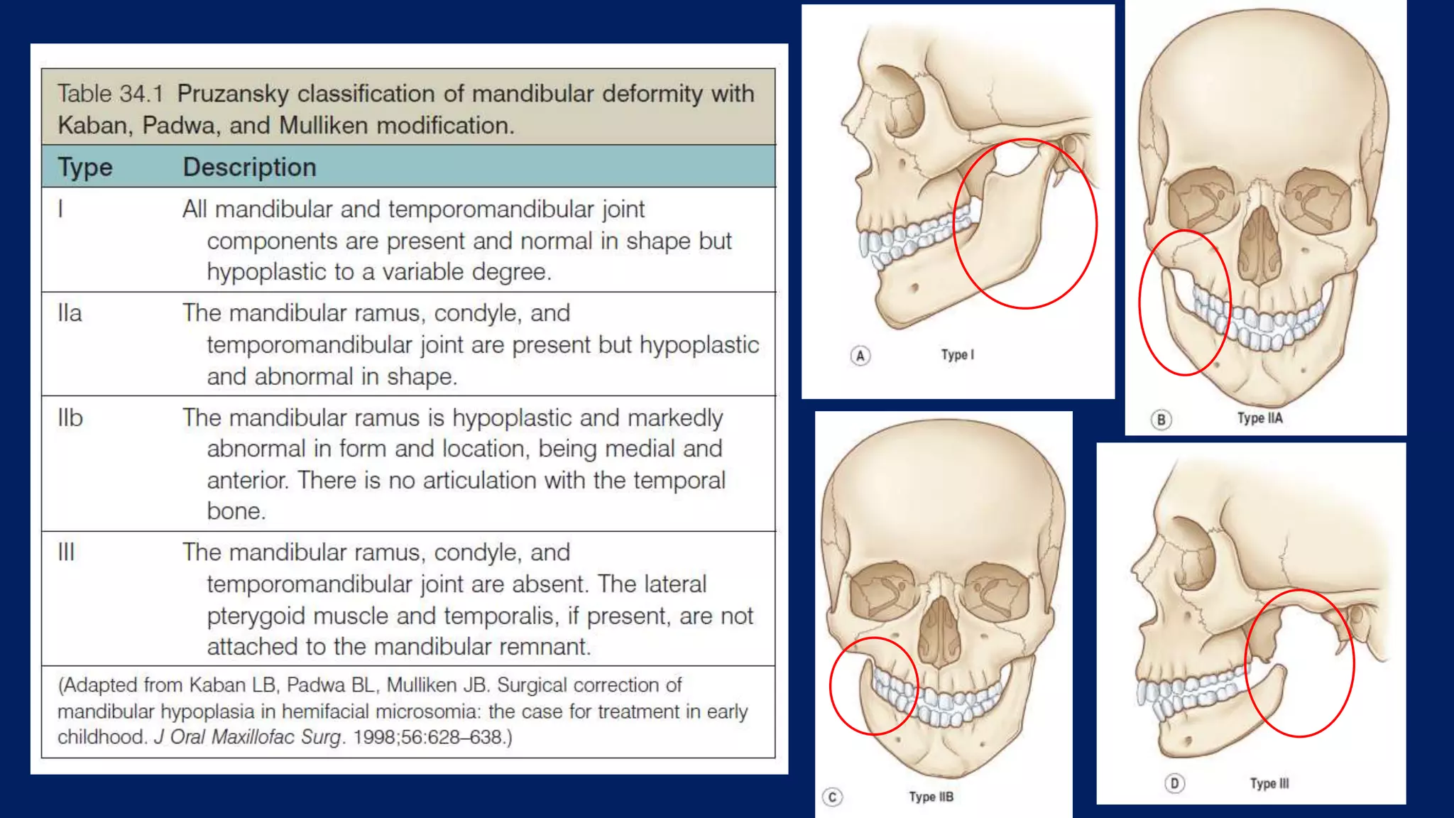 Craniofacial Microsomia and Hemifacial Atrophy | PPTX