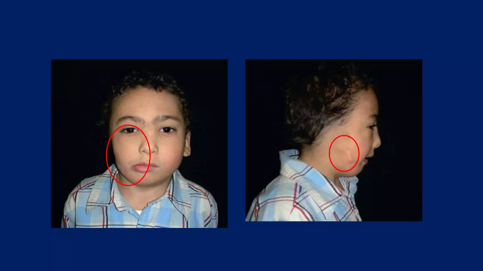 Craniofacial Microsomia and Hemifacial Atrophy | PPTX