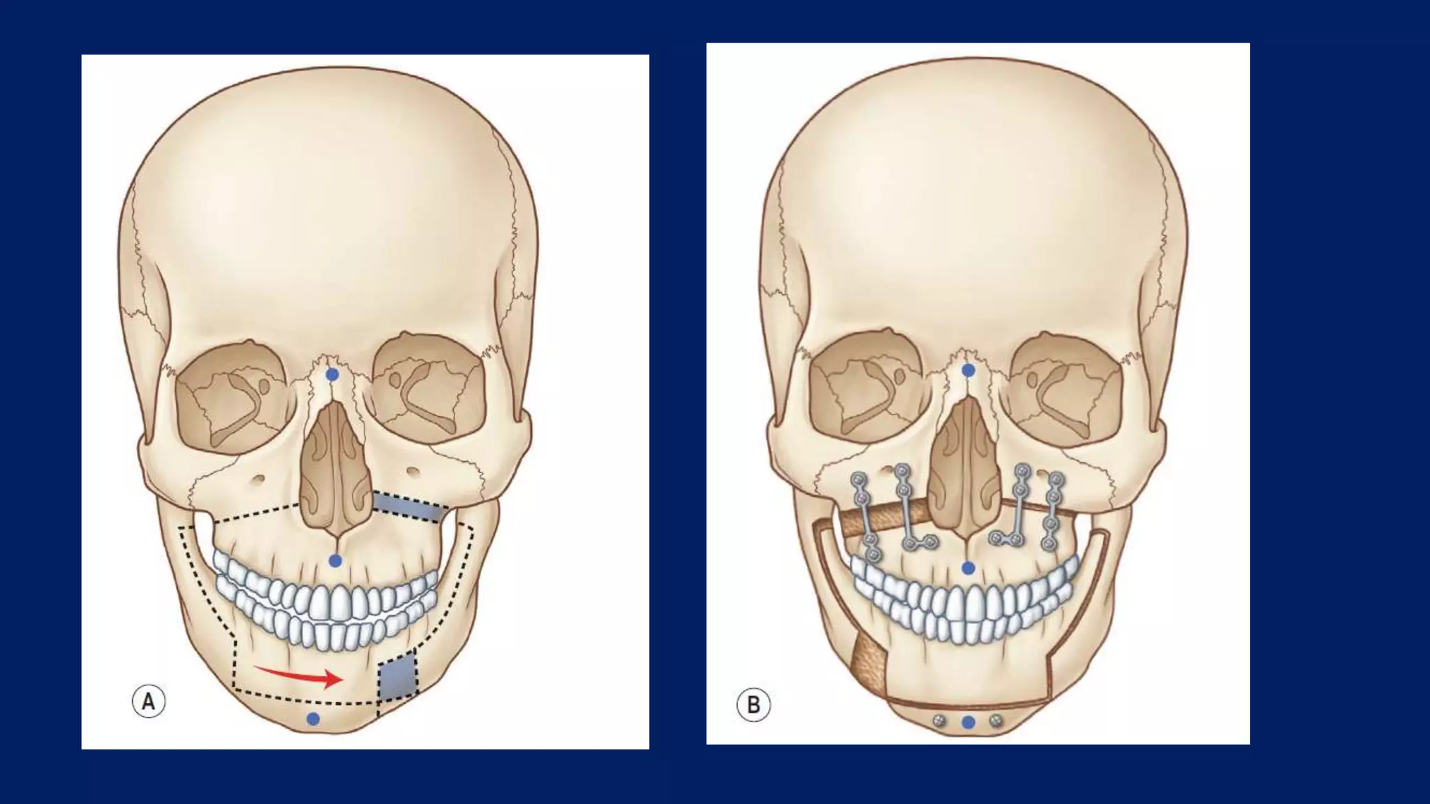 Craniofacial Microsomia and Hemifacial Atrophy | PPTX