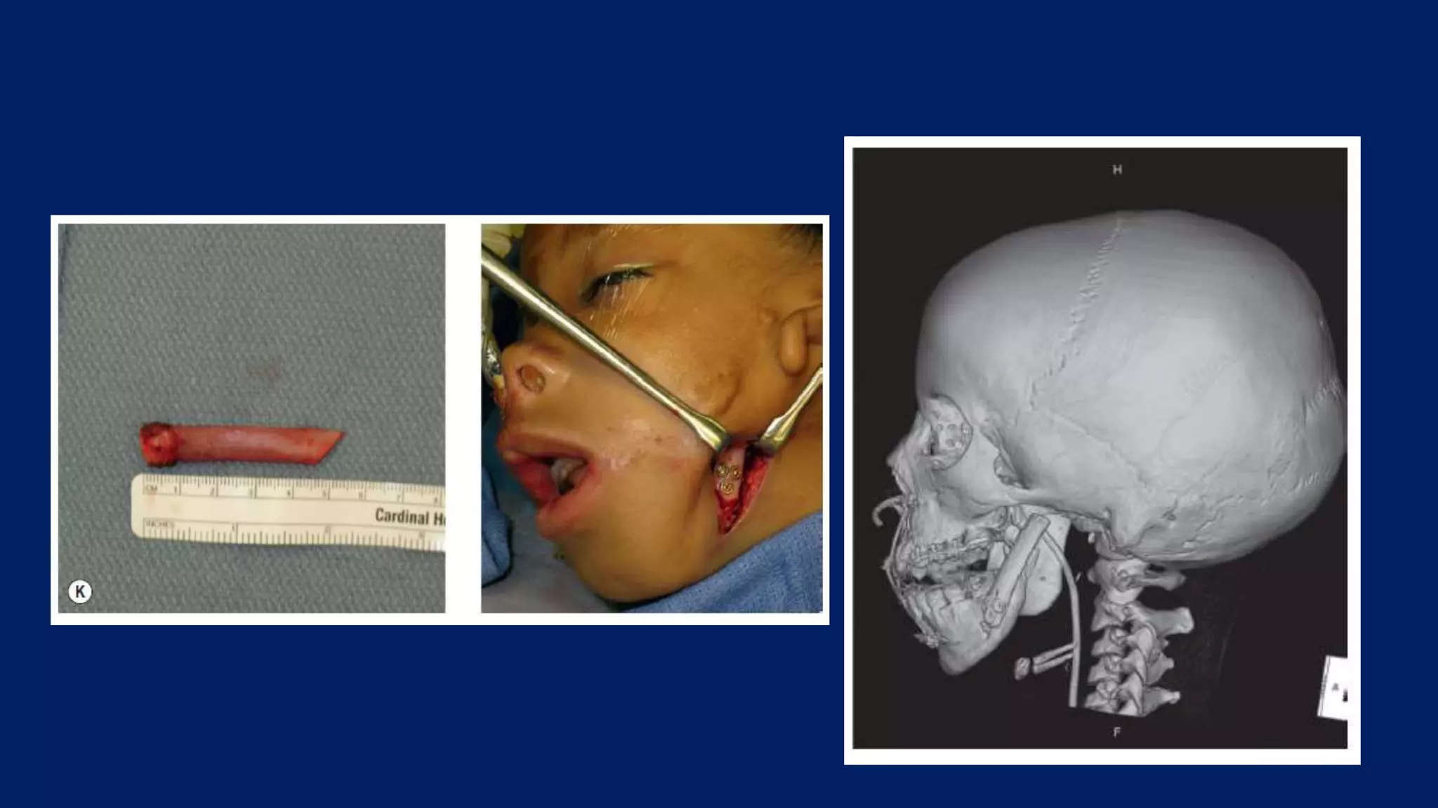 Craniofacial Microsomia and Hemifacial Atrophy | PPTX