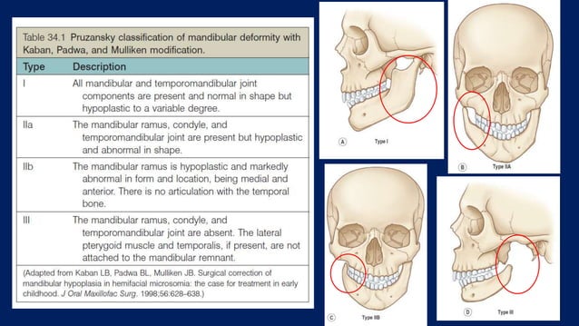 Craniofacial Microsomia and Hemifacial Atrophy | PPTX | Pregnancy ...