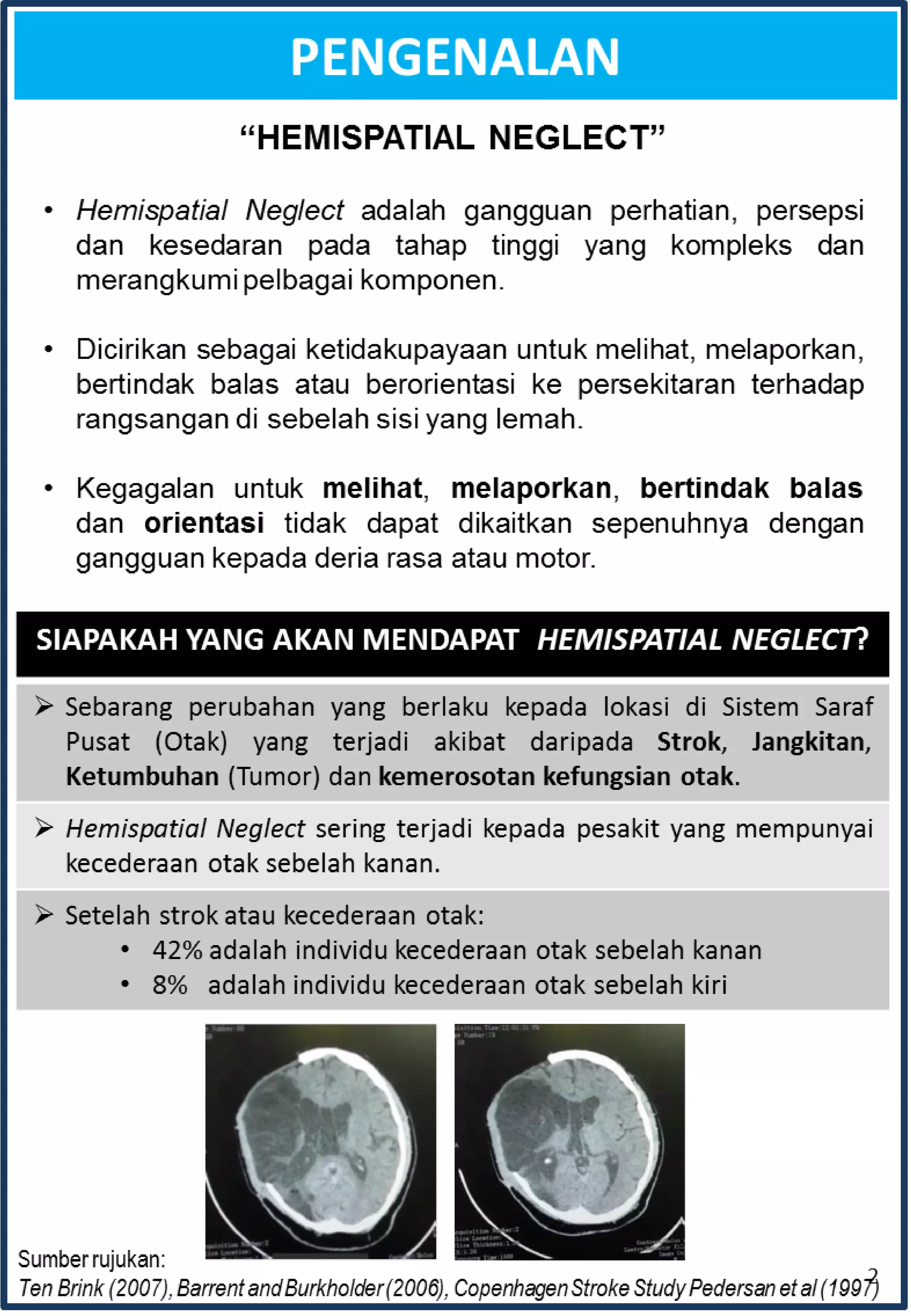 Hemispatial Neglect | PDF