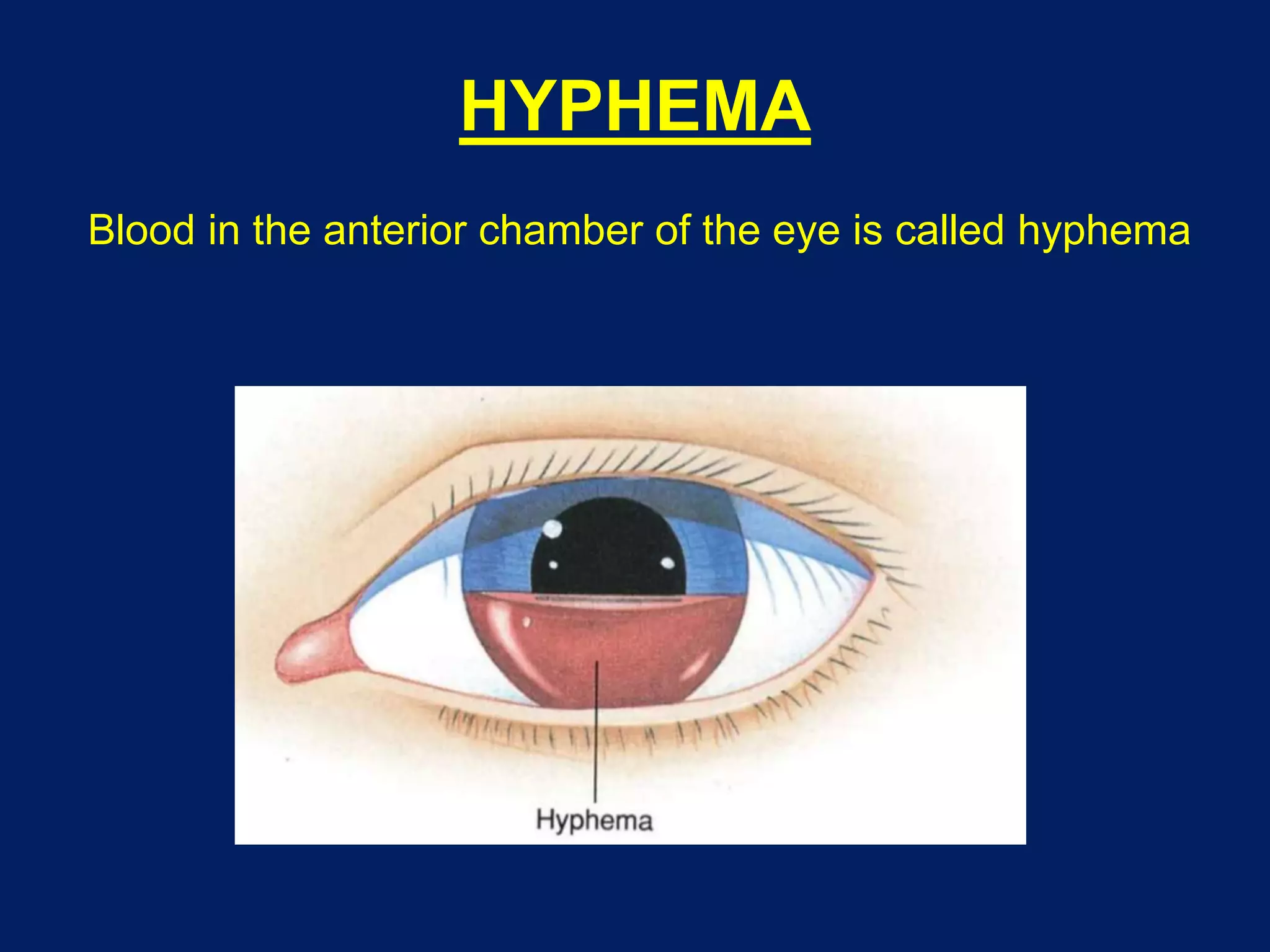 Hyphema | PPT