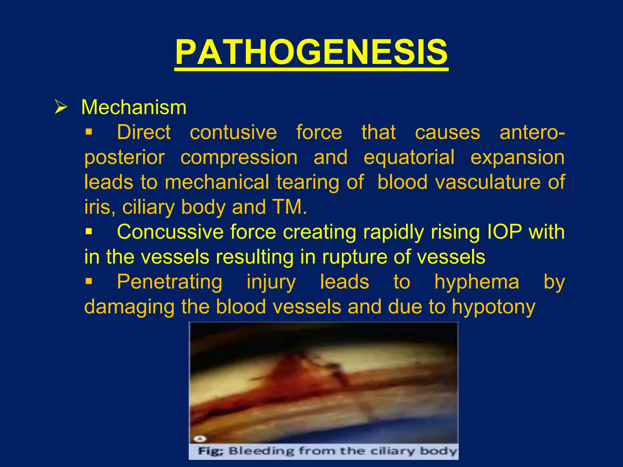 Hyphema | PPT