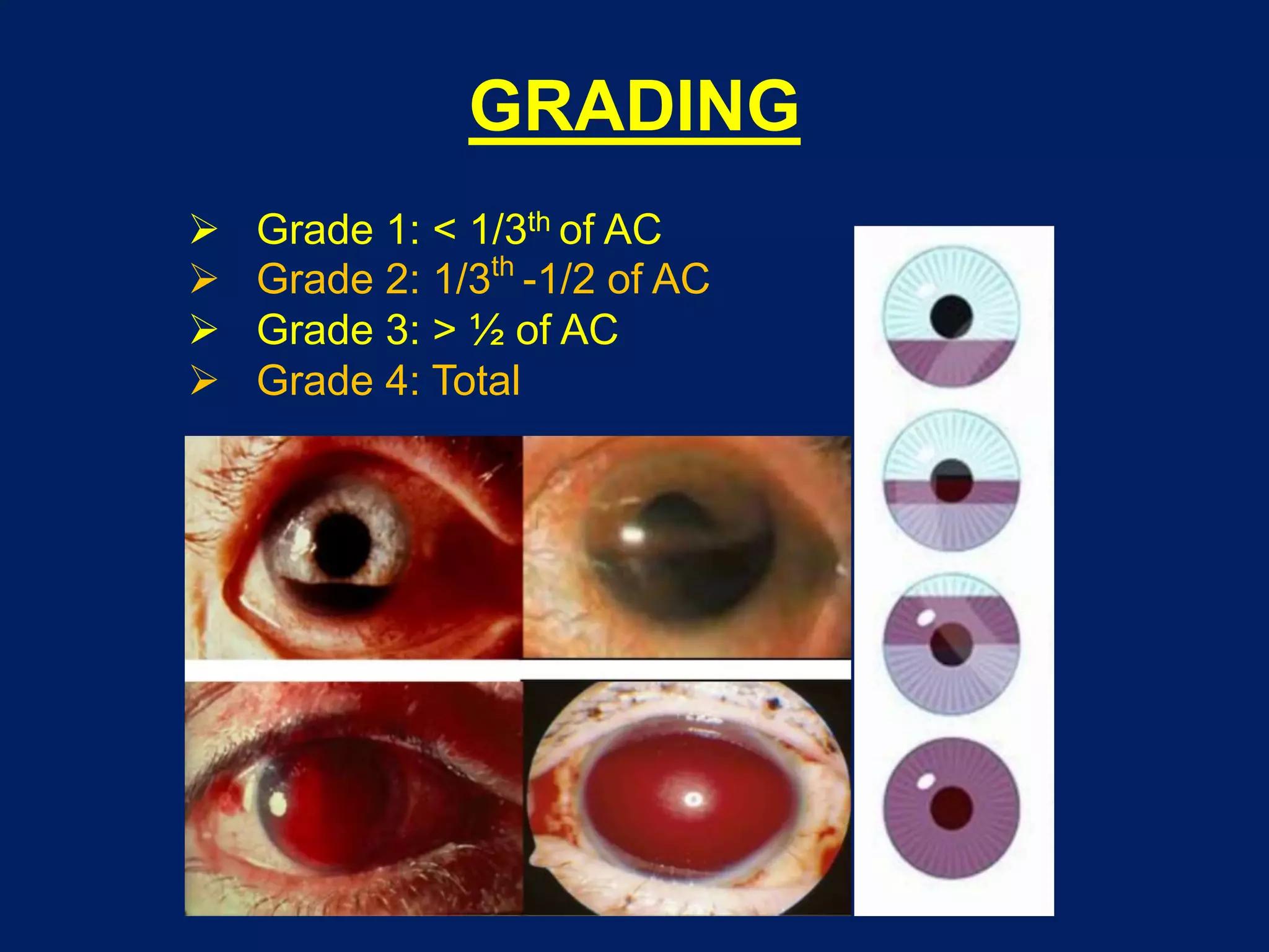 Hyphema | PPT