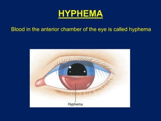 Hyphema | PPT