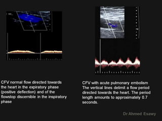19 cardaic effects on peripheral vascular doppler dr ahmed esawy | PPT