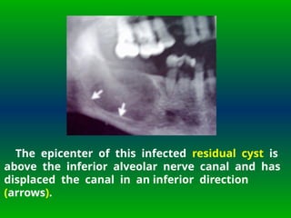 19-CYSTS.ppt_20250314_161747_0000.pptx ppt for omr | PPTX