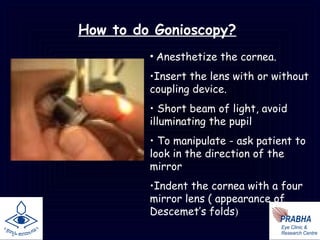 19 gonioscopy | PPT