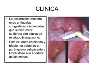 19. hipertrofia amigdalar | PPTX