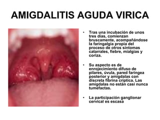 19. hipertrofia amigdalar | PPTX