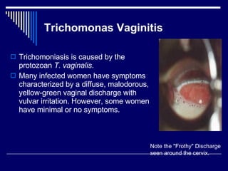 Bacterial Vaginosis Discharge In Women