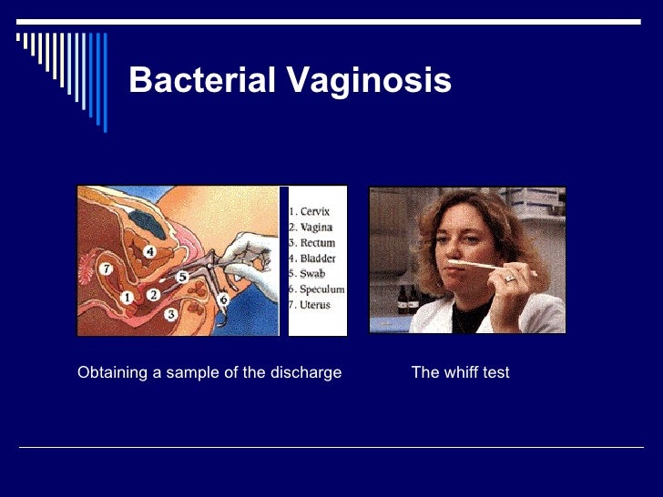 19.Infection Of Vaginal