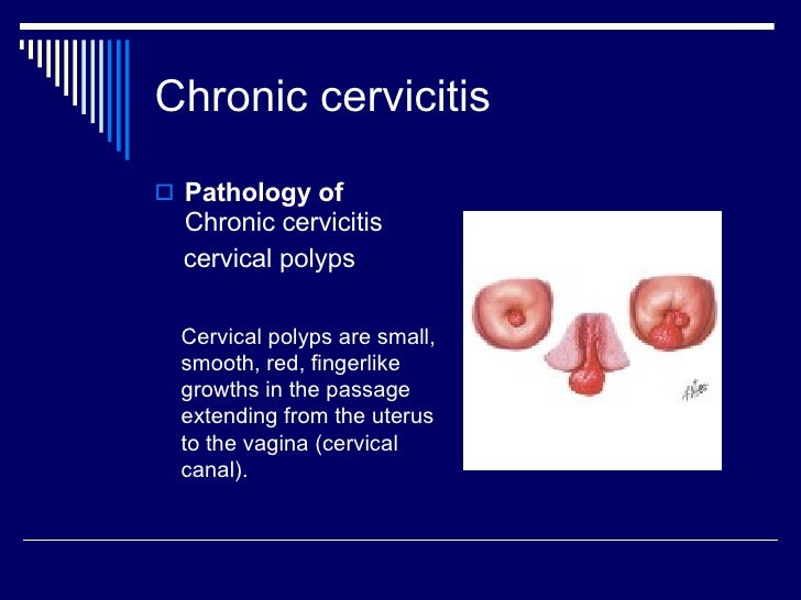 19.Infection Of Vaginal