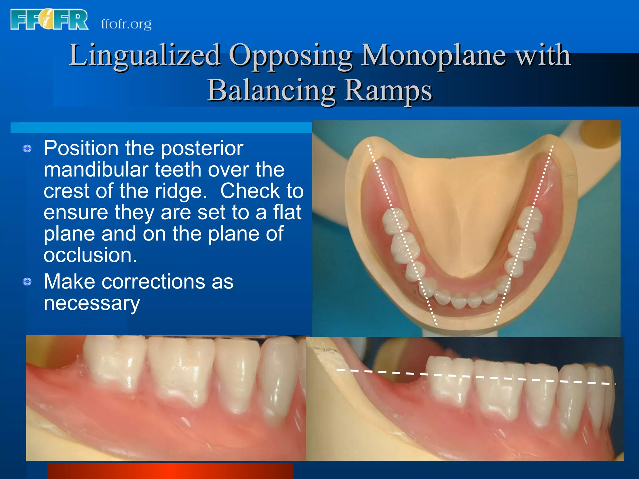 19. occlusal schemes lingualizied oposing monoplane with balancing ...