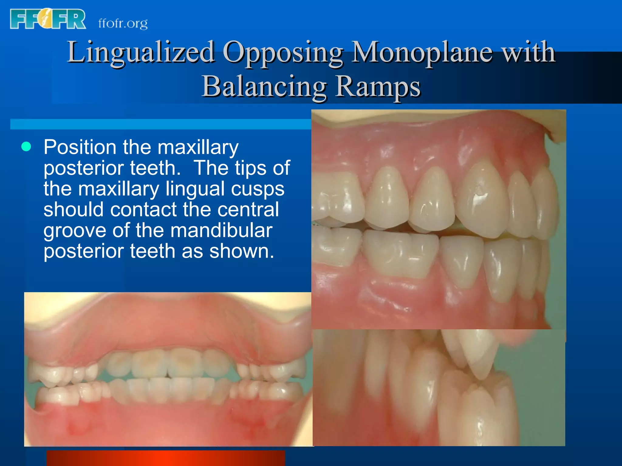 19. occlusal schemes lingualizied oposing monoplane with balancing ...