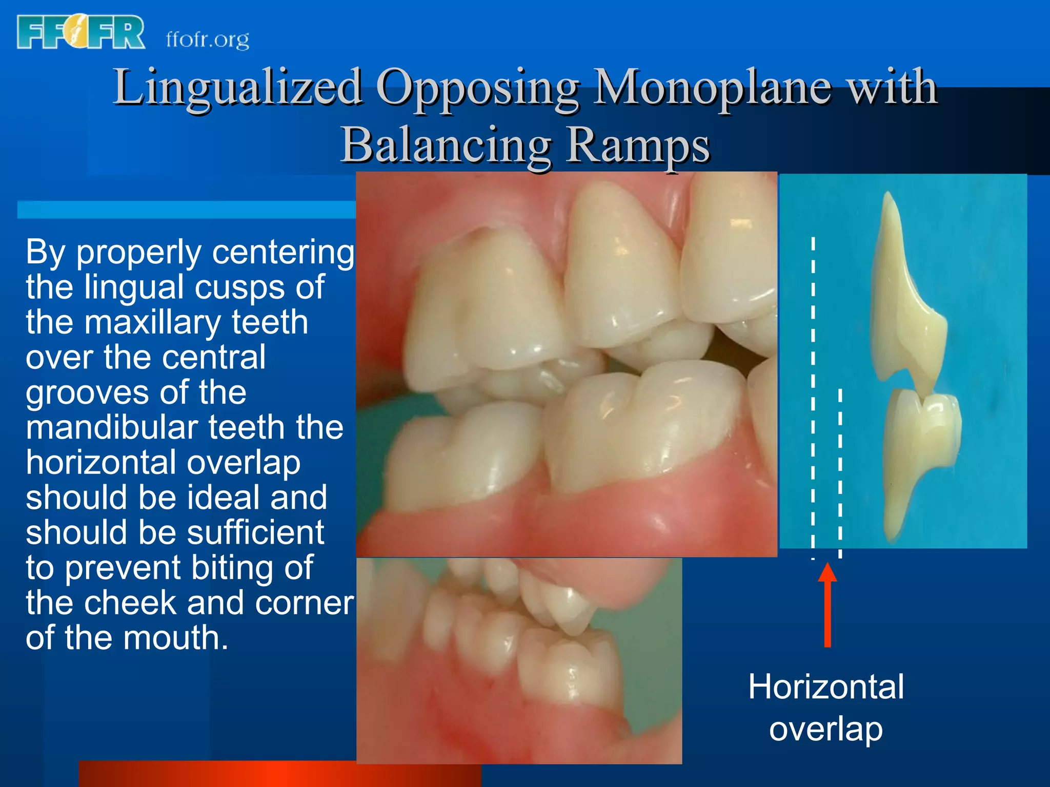 19. occlusal schemes lingualizied oposing monoplane with balancing ...
