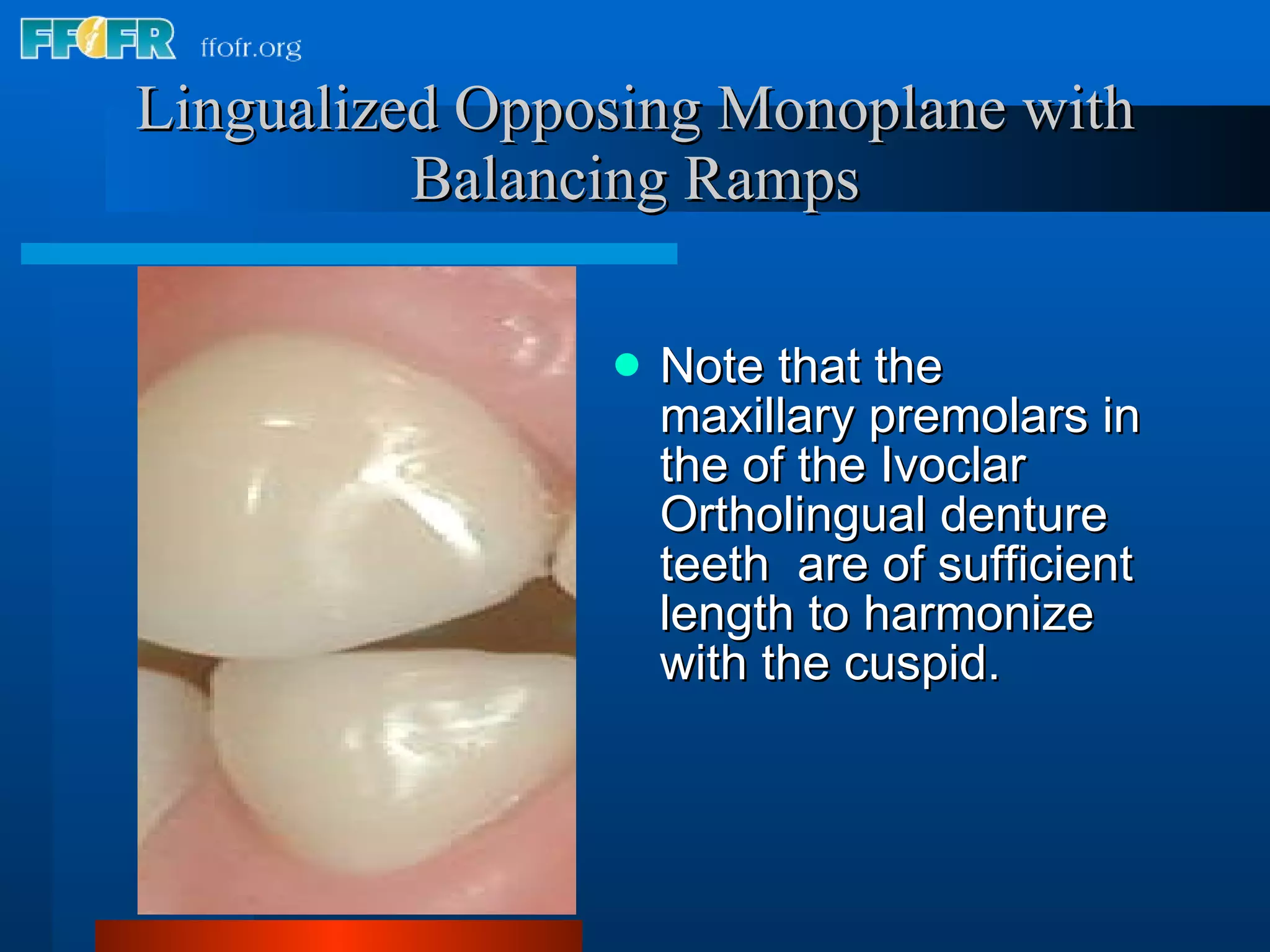 19. occlusal schemes lingualizied oposing monoplane with balancing ...