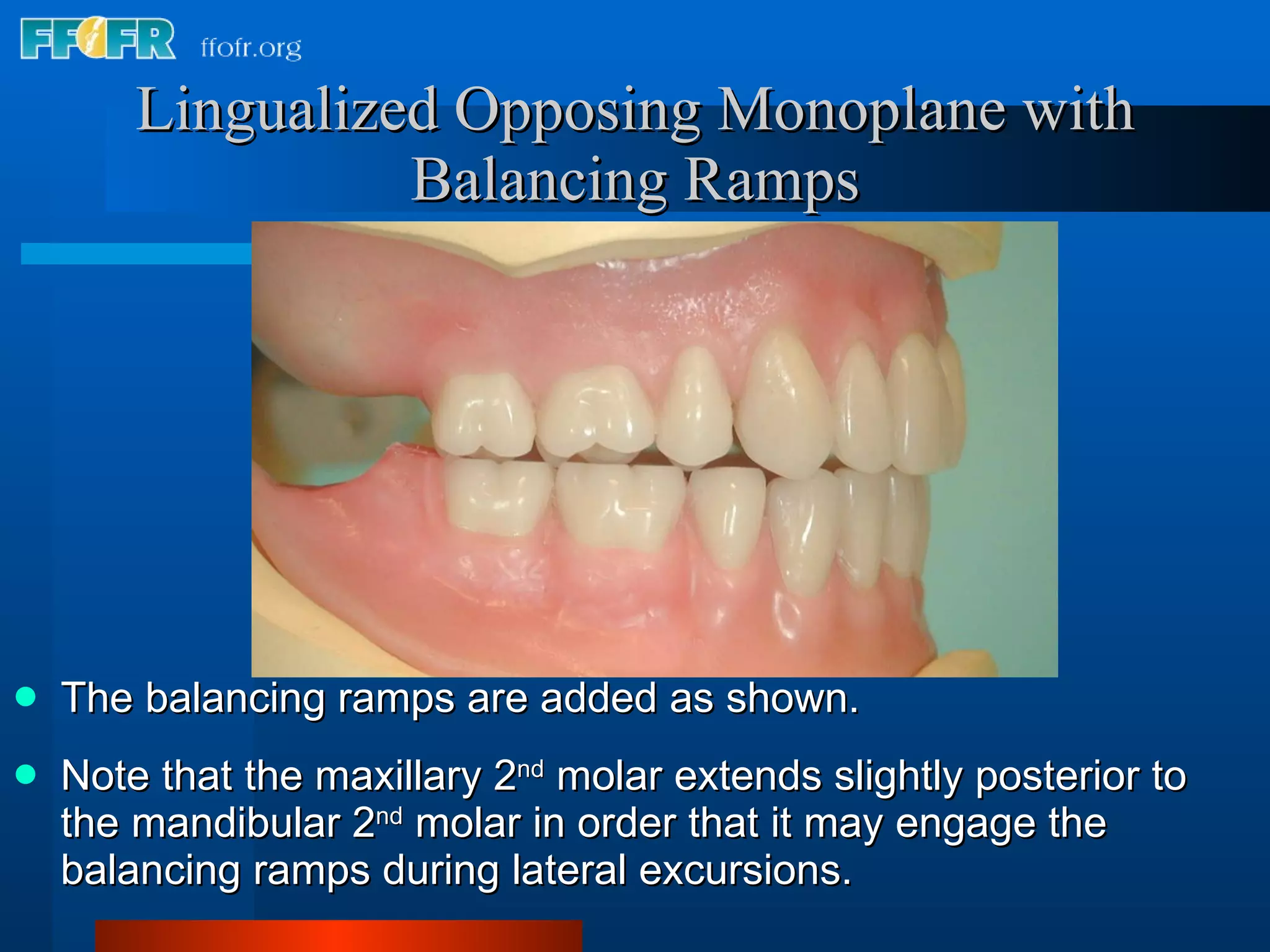 19. occlusal schemes lingualizied oposing monoplane with balancing ...