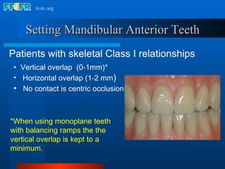 19. occlusal schemes lingualizied oposing monoplane with balancing ...