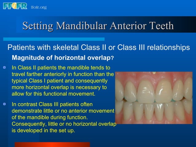 19. occlusal schemes lingualizied oposing monoplane with balancing ...