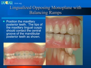 19. occlusal schemes lingualizied oposing monoplane with balancing ...