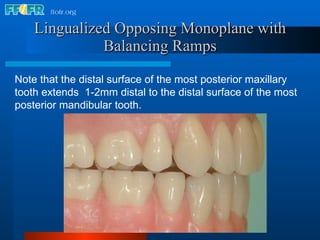19. occlusal schemes lingualizied oposing monoplane with balancing ...