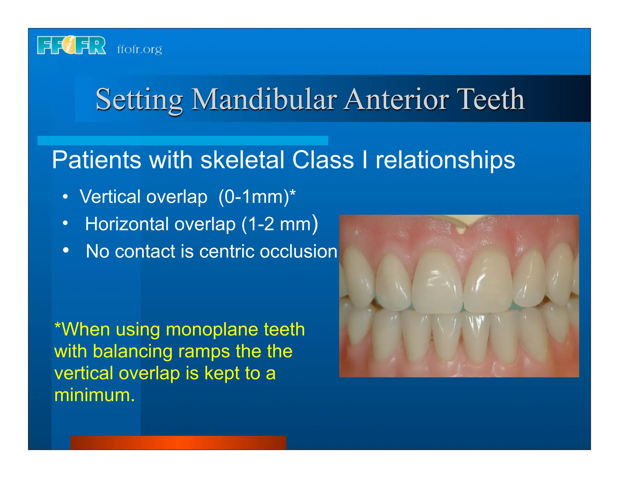 19. occlusal schemes lingualizied oposing monoplane with balancing ...