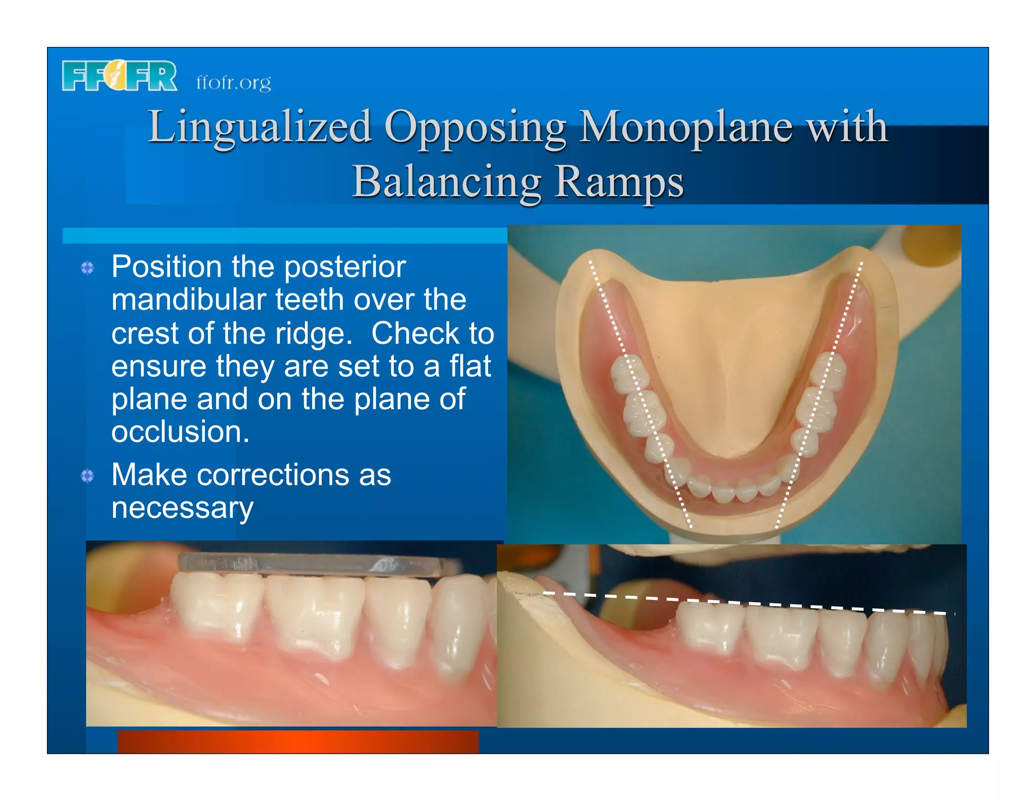 19. occlusal schemes lingualizied oposing monoplane with balancing ...