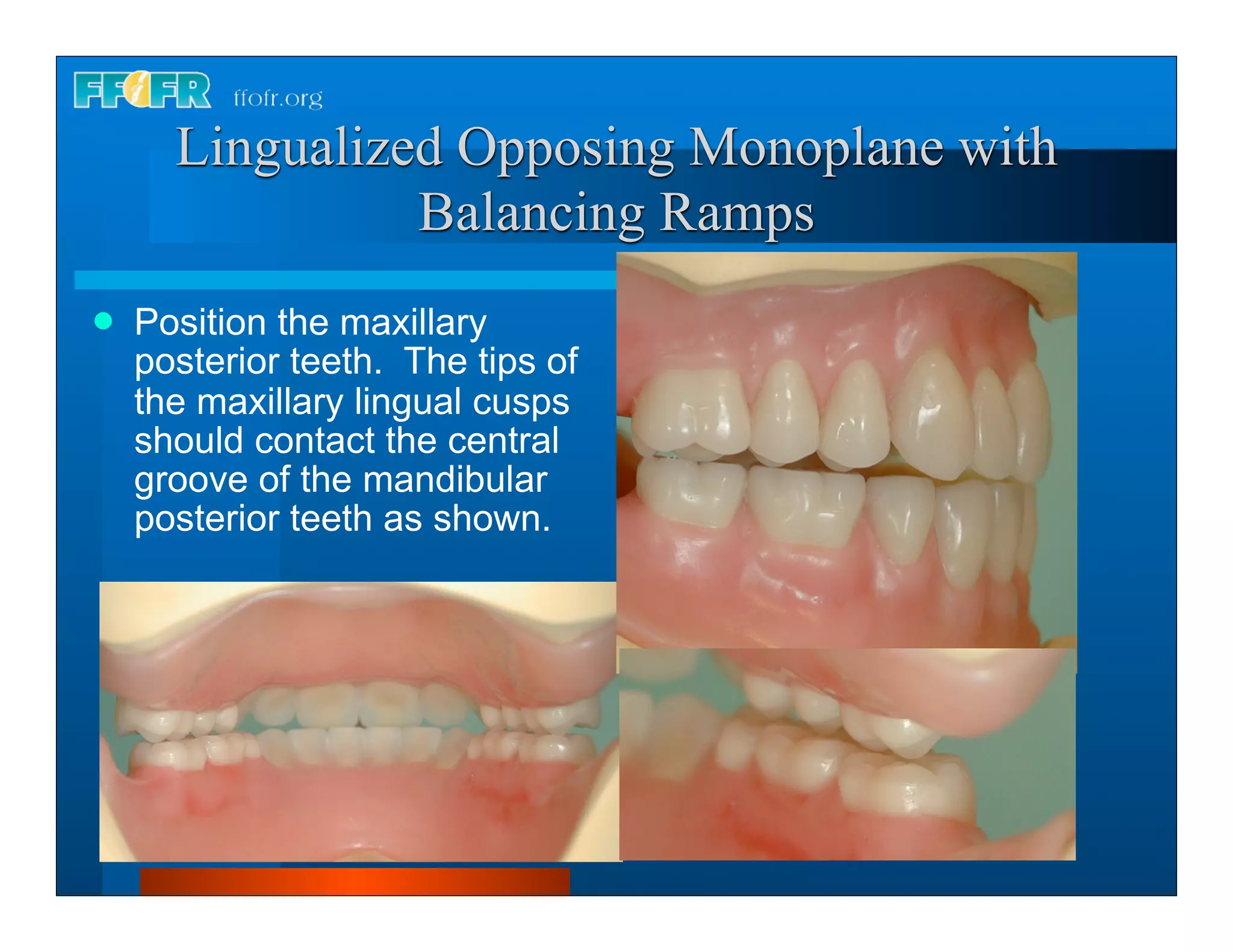 19. occlusal schemes lingualizied oposing monoplane with balancing ...