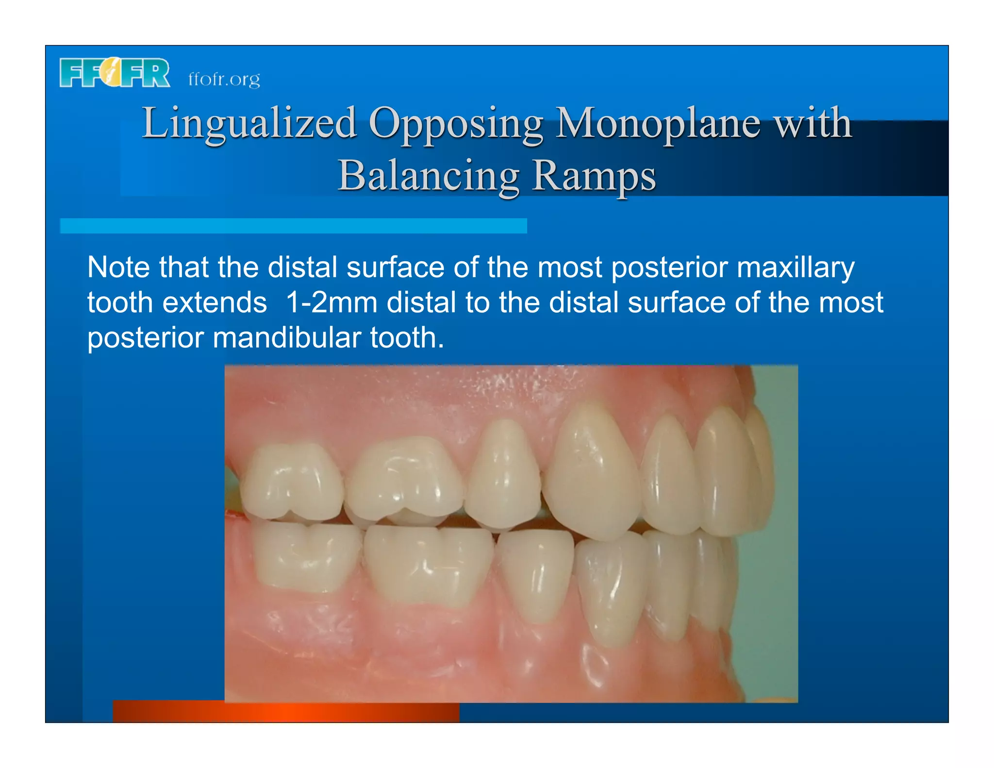 19. occlusal schemes lingualizied oposing monoplane with balancing ...