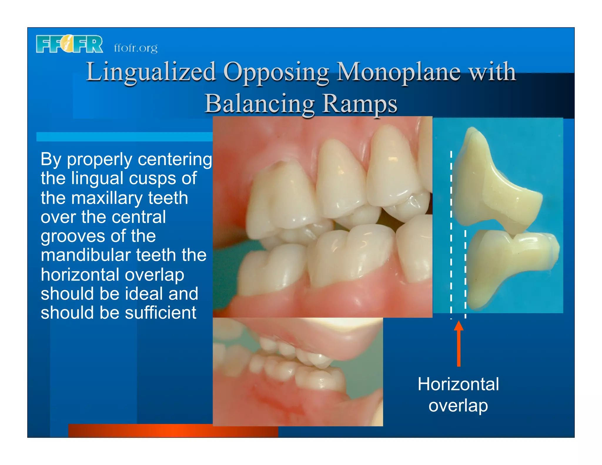 19. occlusal schemes lingualizied oposing monoplane with balancing ...