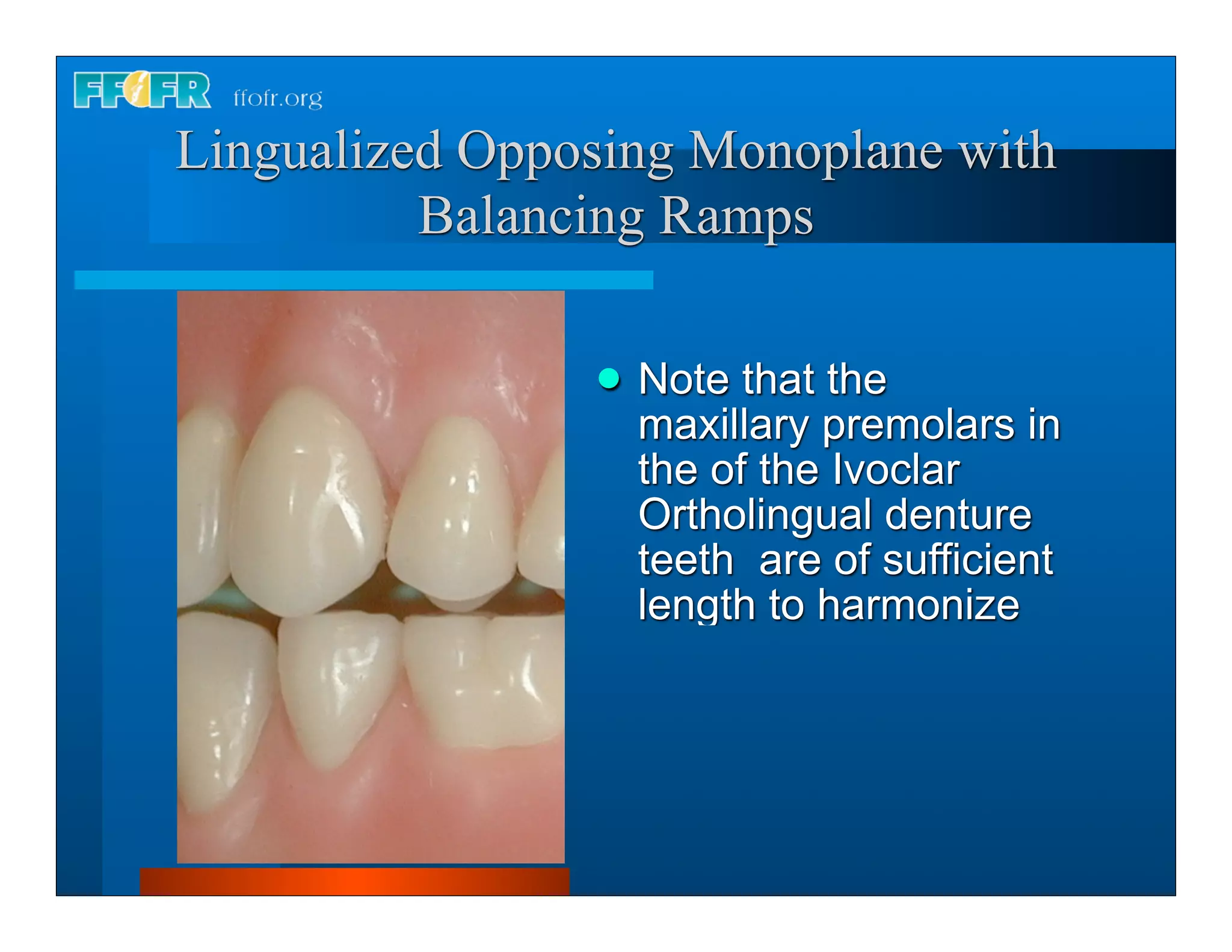 19. occlusal schemes lingualizied oposing monoplane with balancing ...
