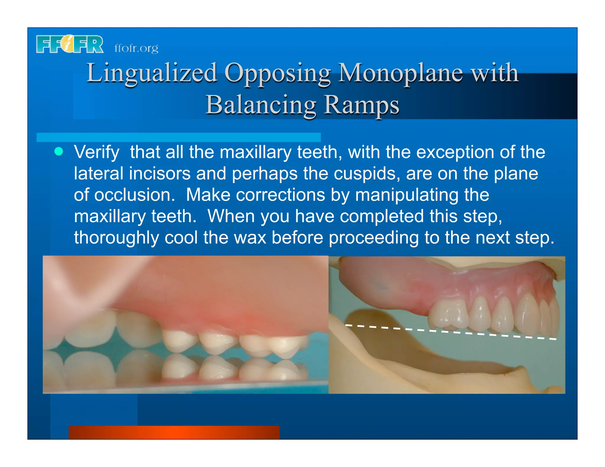 19. occlusal schemes lingualizied oposing monoplane with balancing ...
