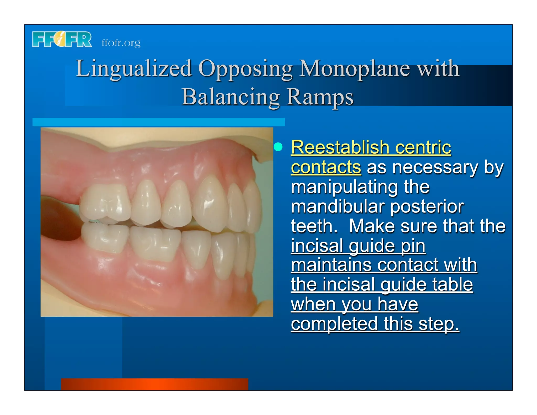 19. occlusal schemes lingualizied oposing monoplane with balancing ...