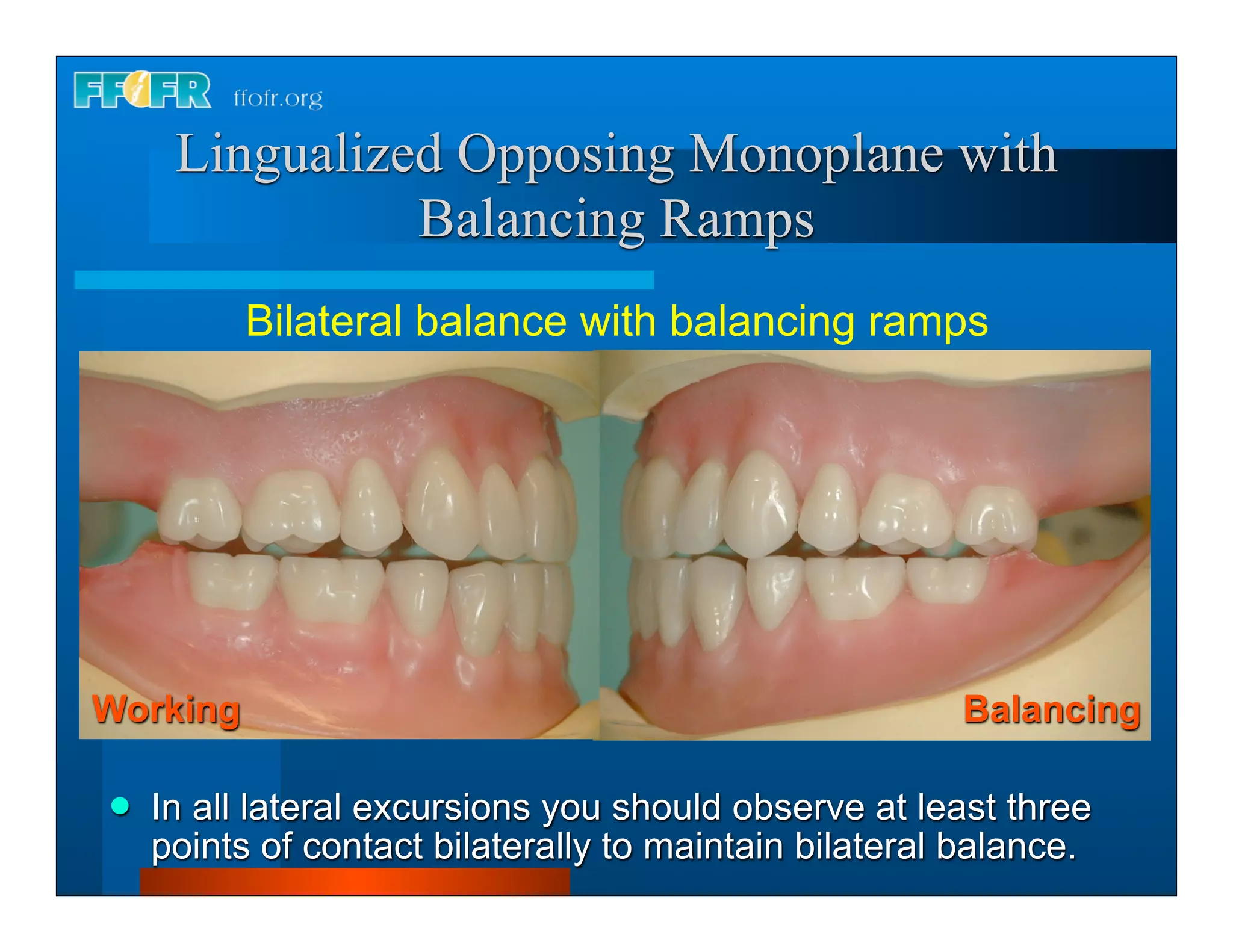 19. occlusal schemes lingualizied oposing monoplane with balancing ...