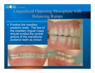 19. occlusal schemes lingualizied oposing monoplane with balancing ...