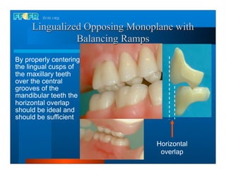 19. occlusal schemes lingualizied oposing monoplane with balancing ...