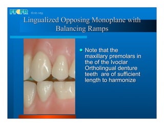 19. occlusal schemes lingualizied oposing monoplane with balancing ...