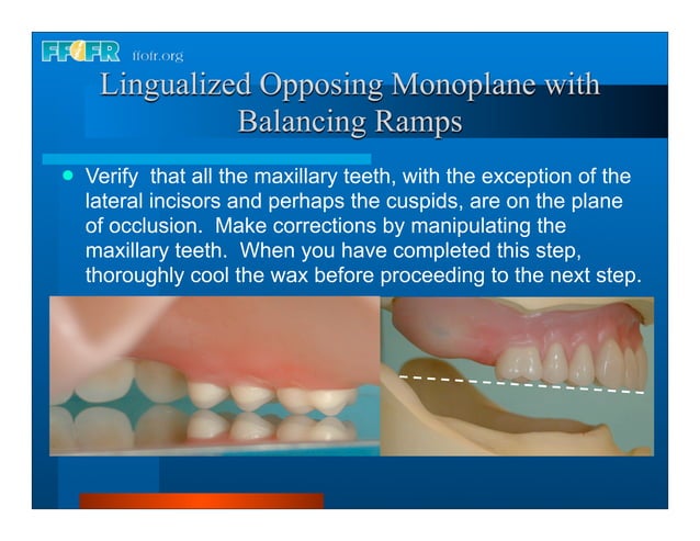 19. occlusal schemes lingualizied oposing monoplane with balancing ...
